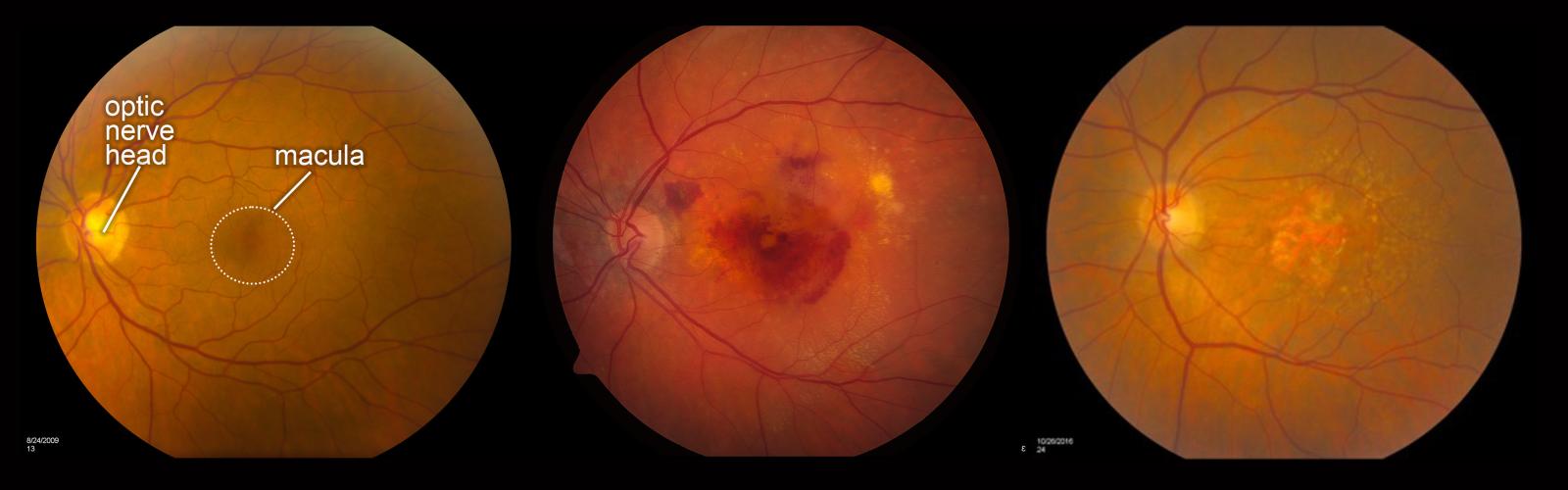 Story of discovery: NEI-funded research paves way for new dry AMD drugs | National Eye Institute
